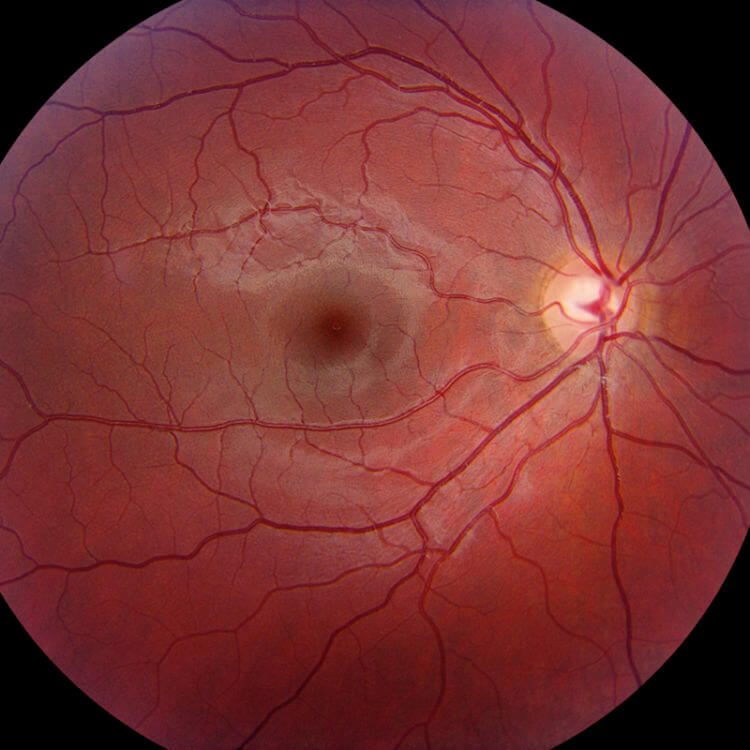 Normal_retina.002_800_web | Wills Eye Hospital