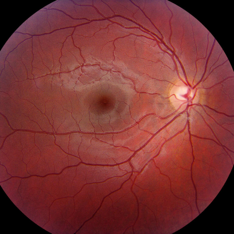Normal_retina.002_800_web | Wills Eye Hospital