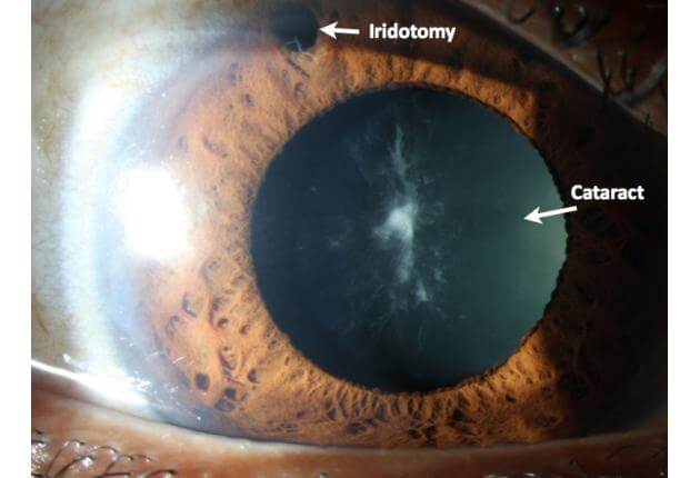 Laser Peripheral Iridotomy | Wills Eye Hospital