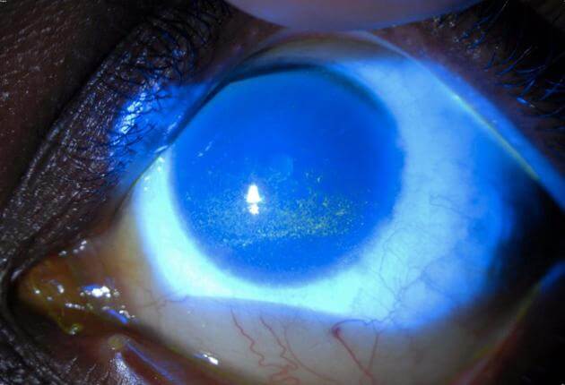 SPK Fluorescein Stain In Dry Eyes Wills Eye Hospital