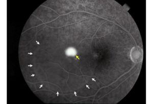 Central Serous Chorioretinopathy (CSCR) | Wills Eye Hospital
