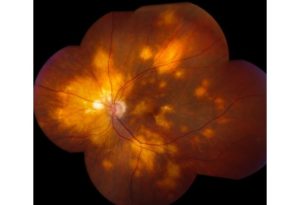 Choroidal Metastasis | Wills Eye Hospital