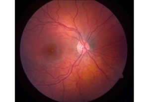Choroidal Nevus | Wills Eye Hospital