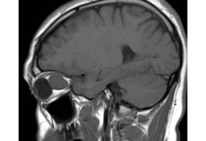 Orbital Tumors Benign | Wills Eye Hospital