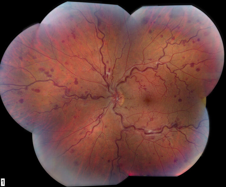 Central Retinal Vein Occlusion (CRVO) | Wills Eye Hospital