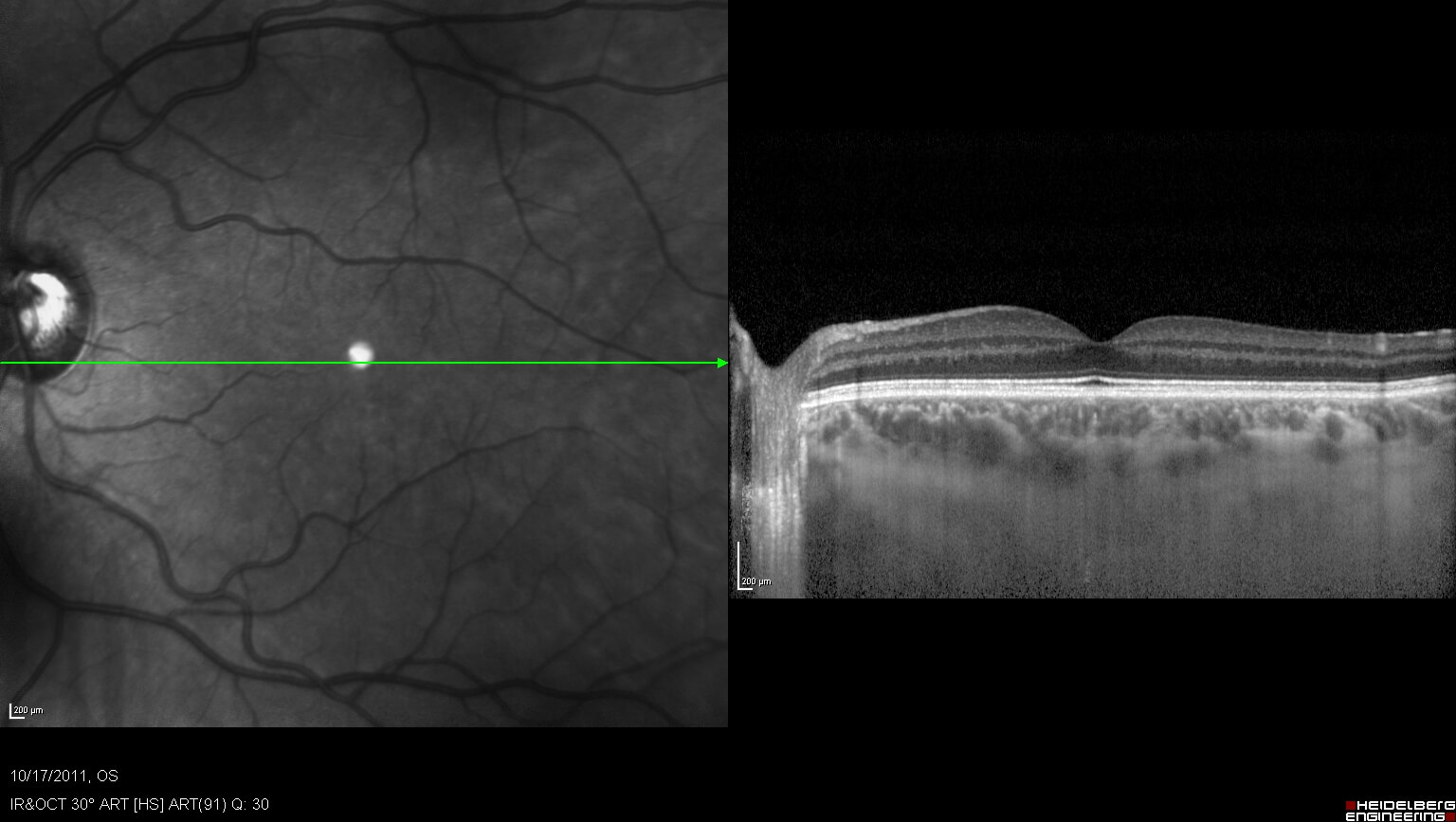 Normal.OCT | Wills Eye Hospital