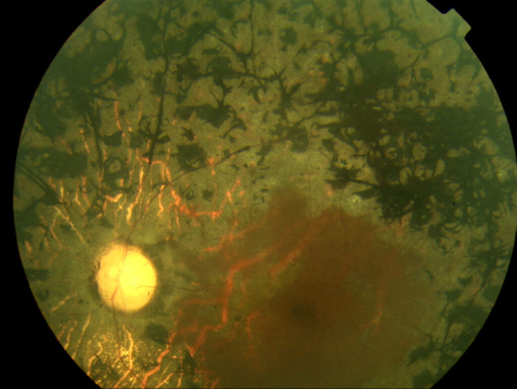 Retinitis Pigmentosa clinical photo 2 | Wills Eye Hospital