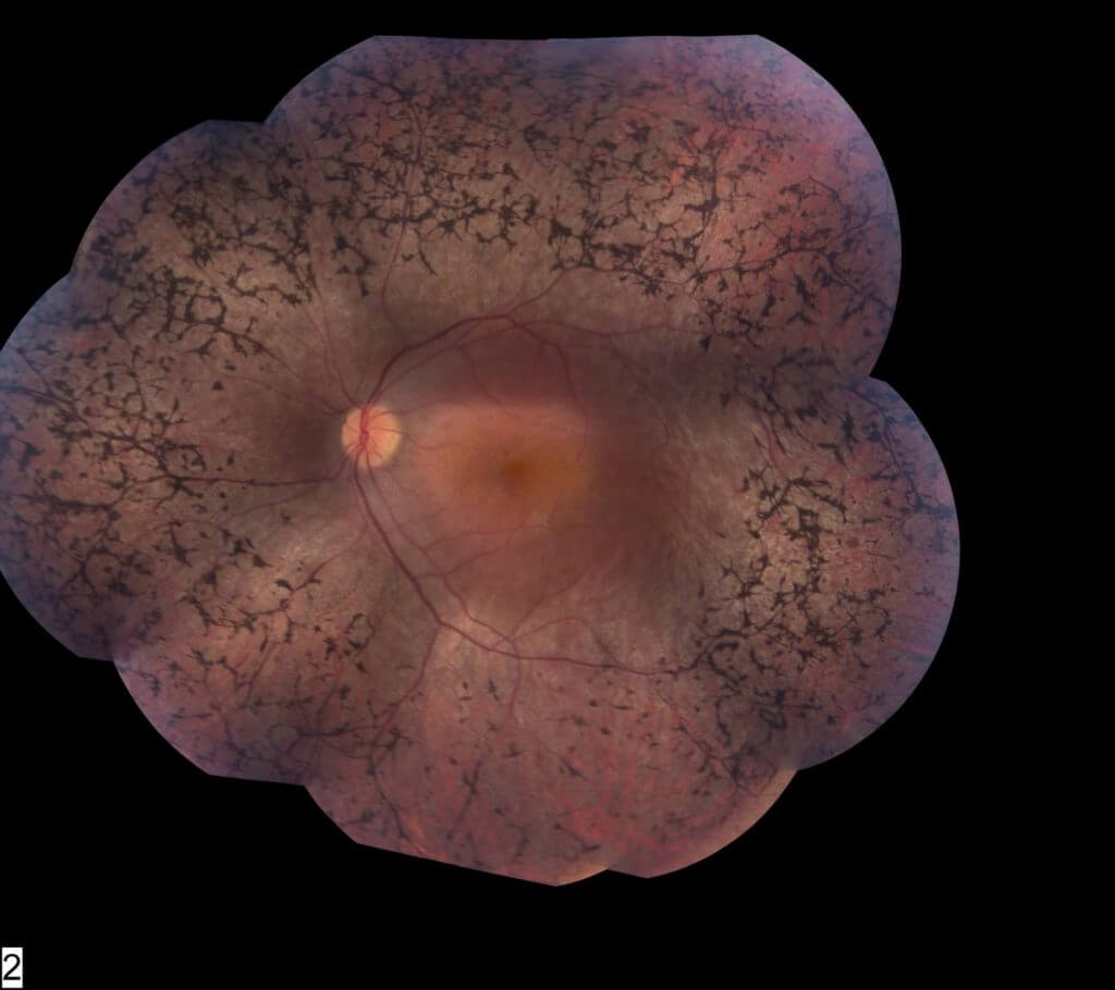 Retinitis Pigmentosa clinical photo 1 | Wills Eye Hospital