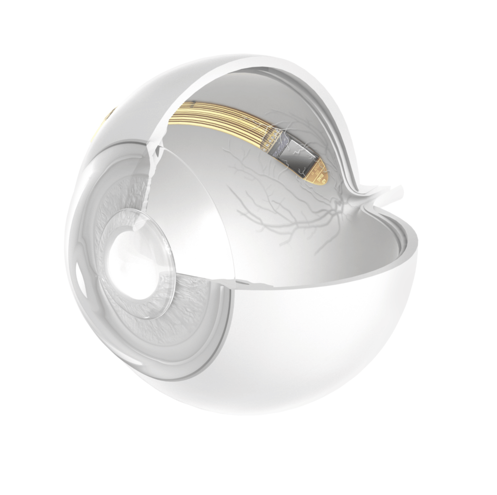 retina implant device | Wills Eye Hospital