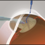 Cataract Surgery, Cataract Treatment, Cataract Removal