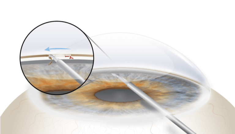 Goniotomy | Wills Eye Hospital