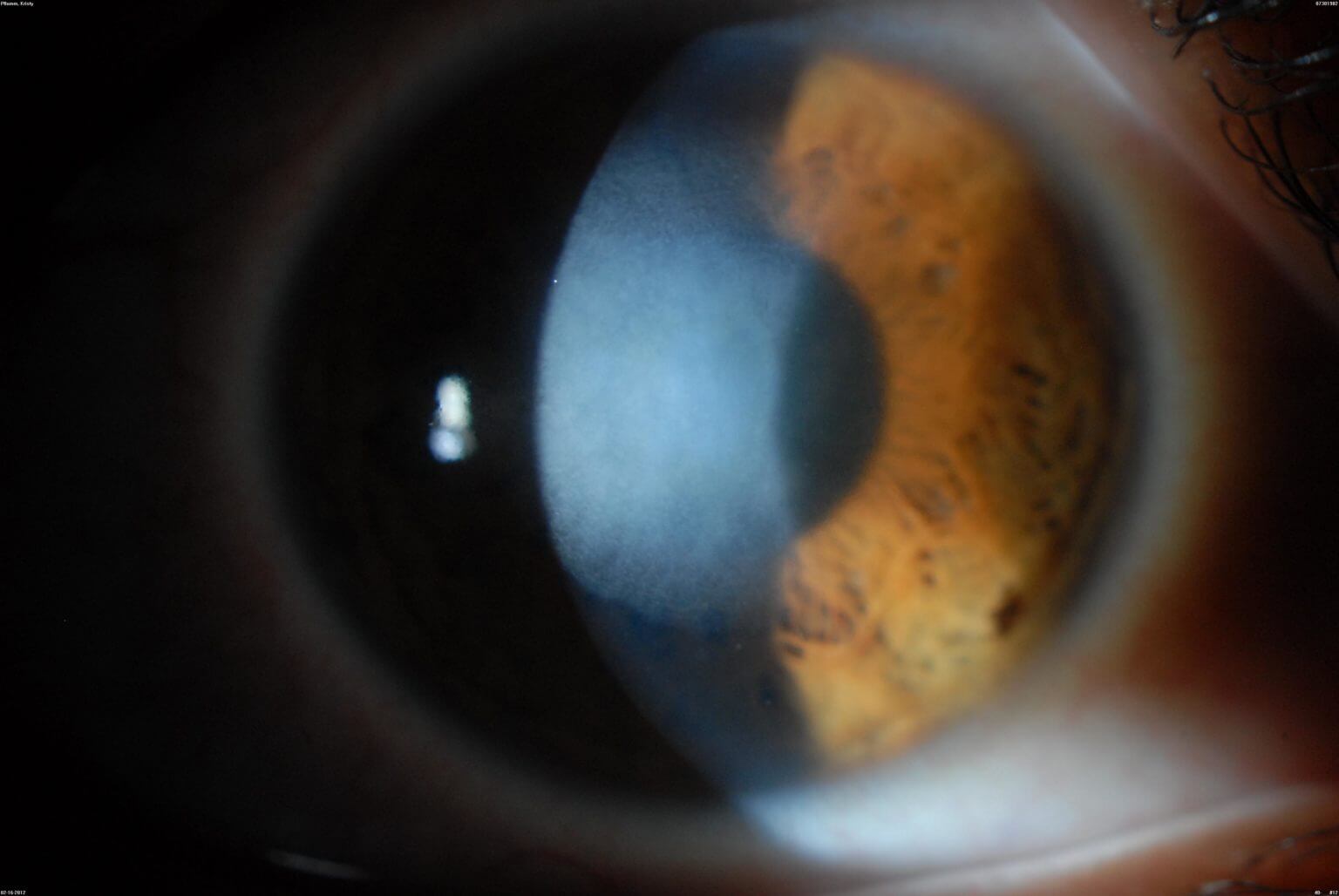 Corneal Dystrophies and Scars | Wills Eye Hospital