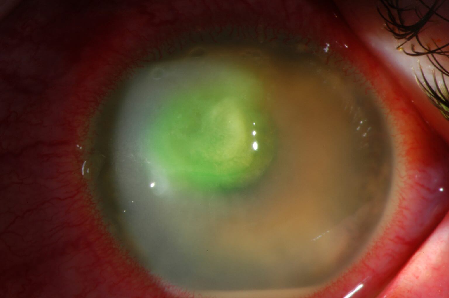 Corneal Disease | Wills Eye Hospital
