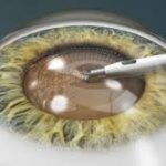 Refractive Lens Exchange (RLE) | Wills Eye Hospital