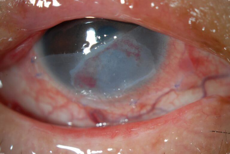 Amniotic Membrane Transplantation (AMT) | Wills Eye Hospital