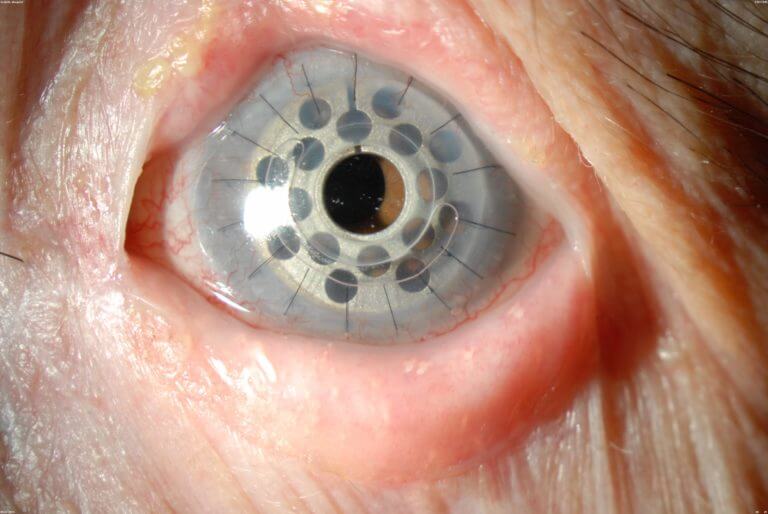 K-pro | Wills Eye Hospital