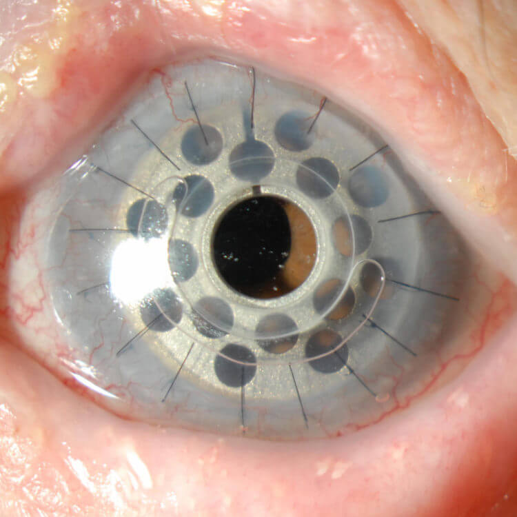 Corneal Surgical Procedures | Wills Eye Hospital