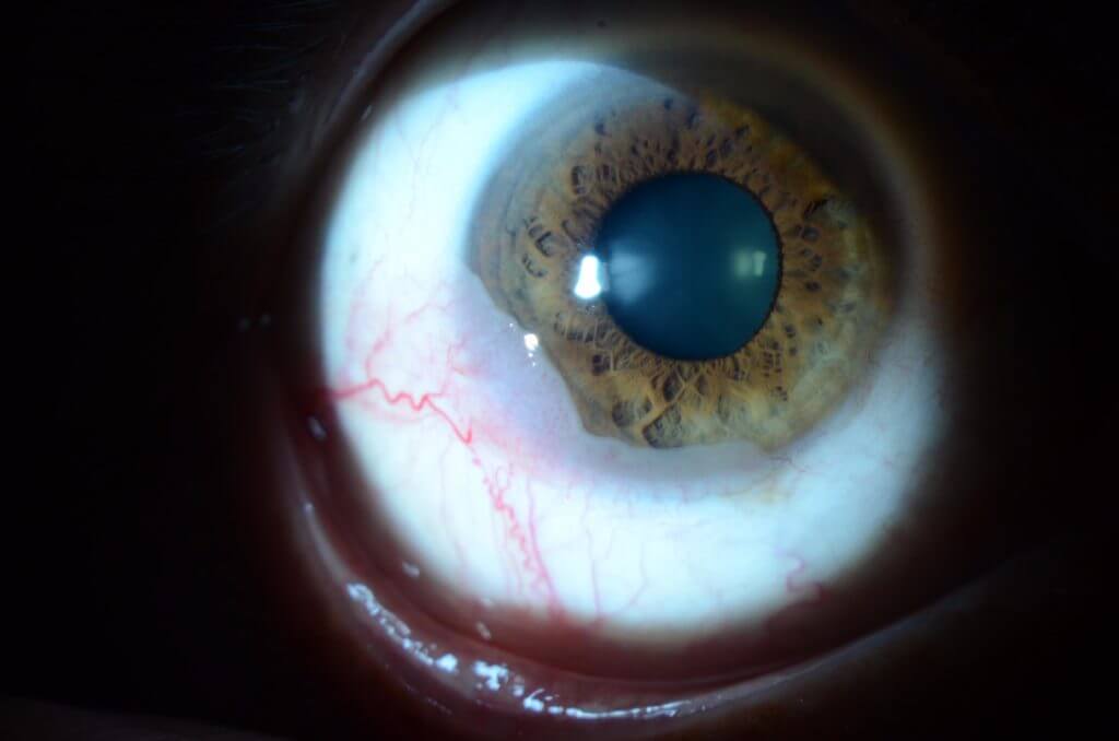 Removal of Conjunctival Lesions | Wills Eye Hospital