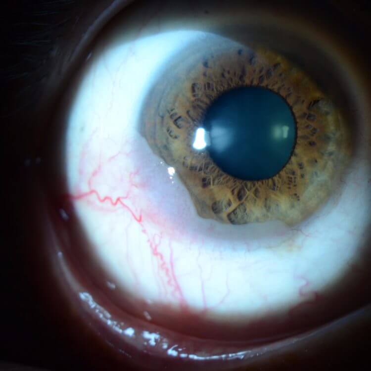 Corneal Surgical Procedures | Wills Eye Hospital