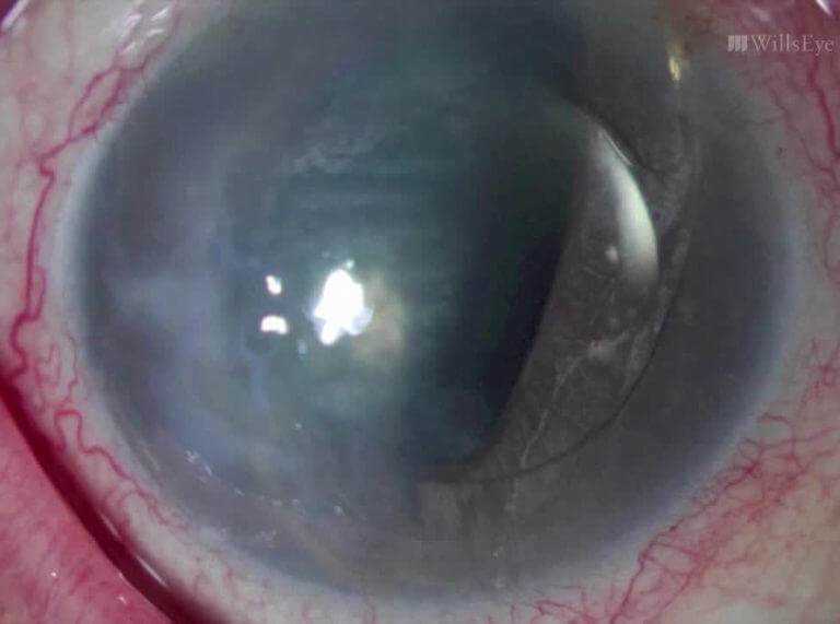 Dislocated Intraocular Lens | Wills Eye Hospital