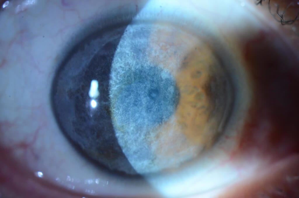 Excimer Laser Phototherapeutic Keratectomy (PTK) | Wills Eye Hospital