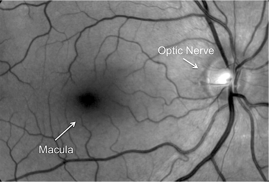 shuman_eye_fig3 | Wills Eye Hospital