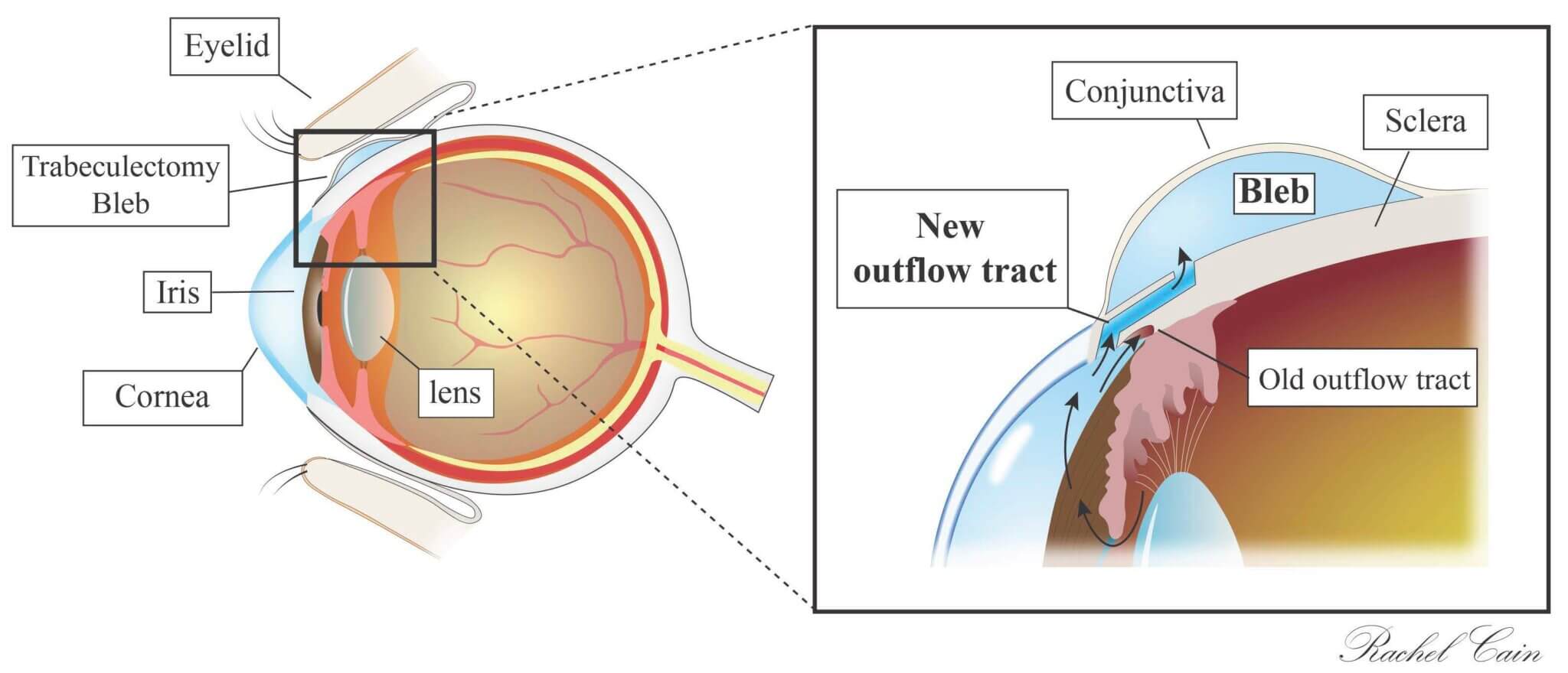 Trabeculectomy Surgery for Glaucoma | Wills Eye Hospital