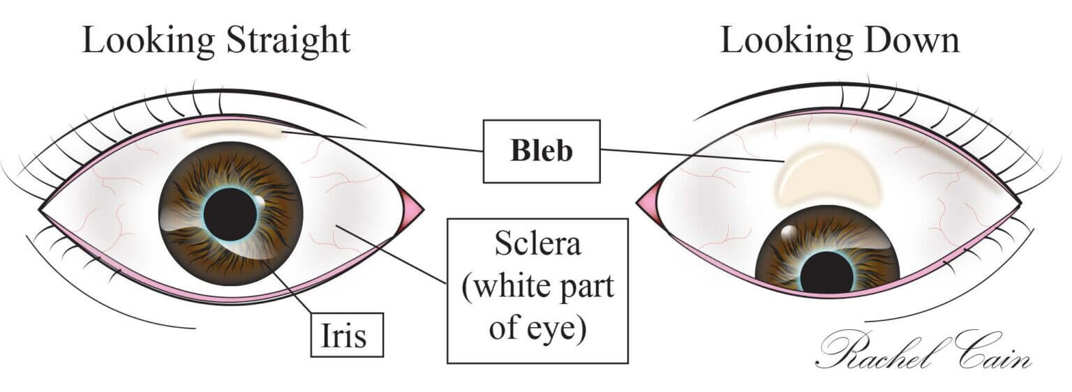 Trabeculectomy Surgery for Glaucoma | Wills Eye Hospital