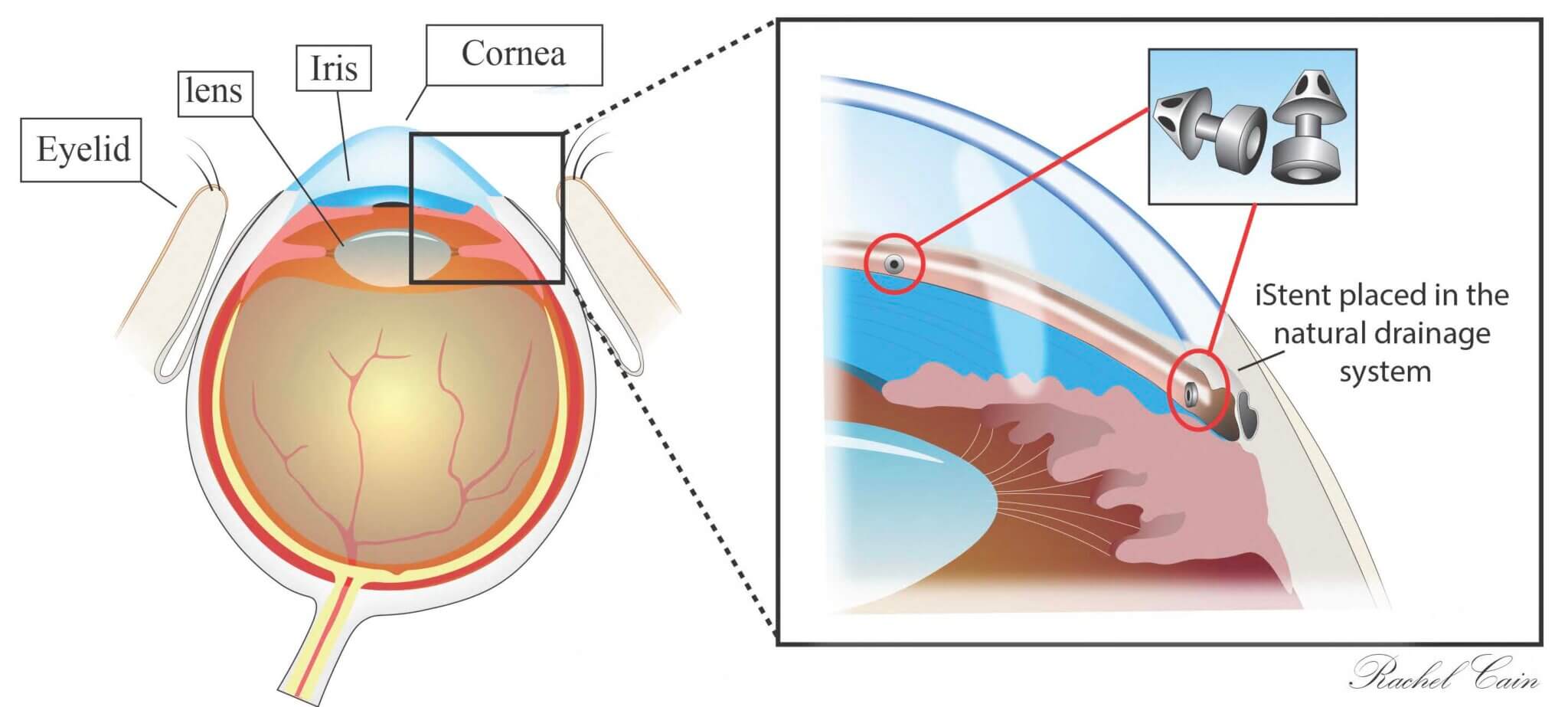 iStent | Wills Eye Hospital