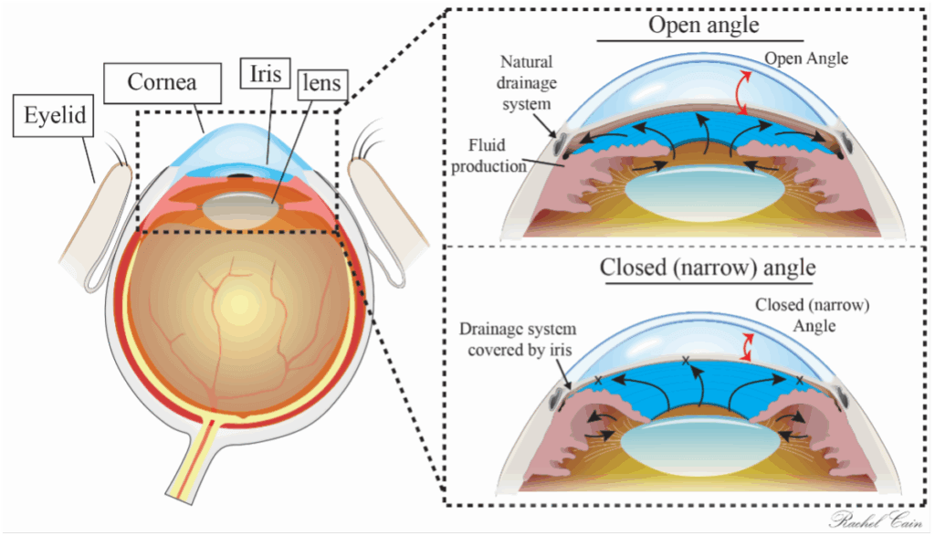 Laser Peripheral Iridotomy (LPI) | Wills Eye Hospital