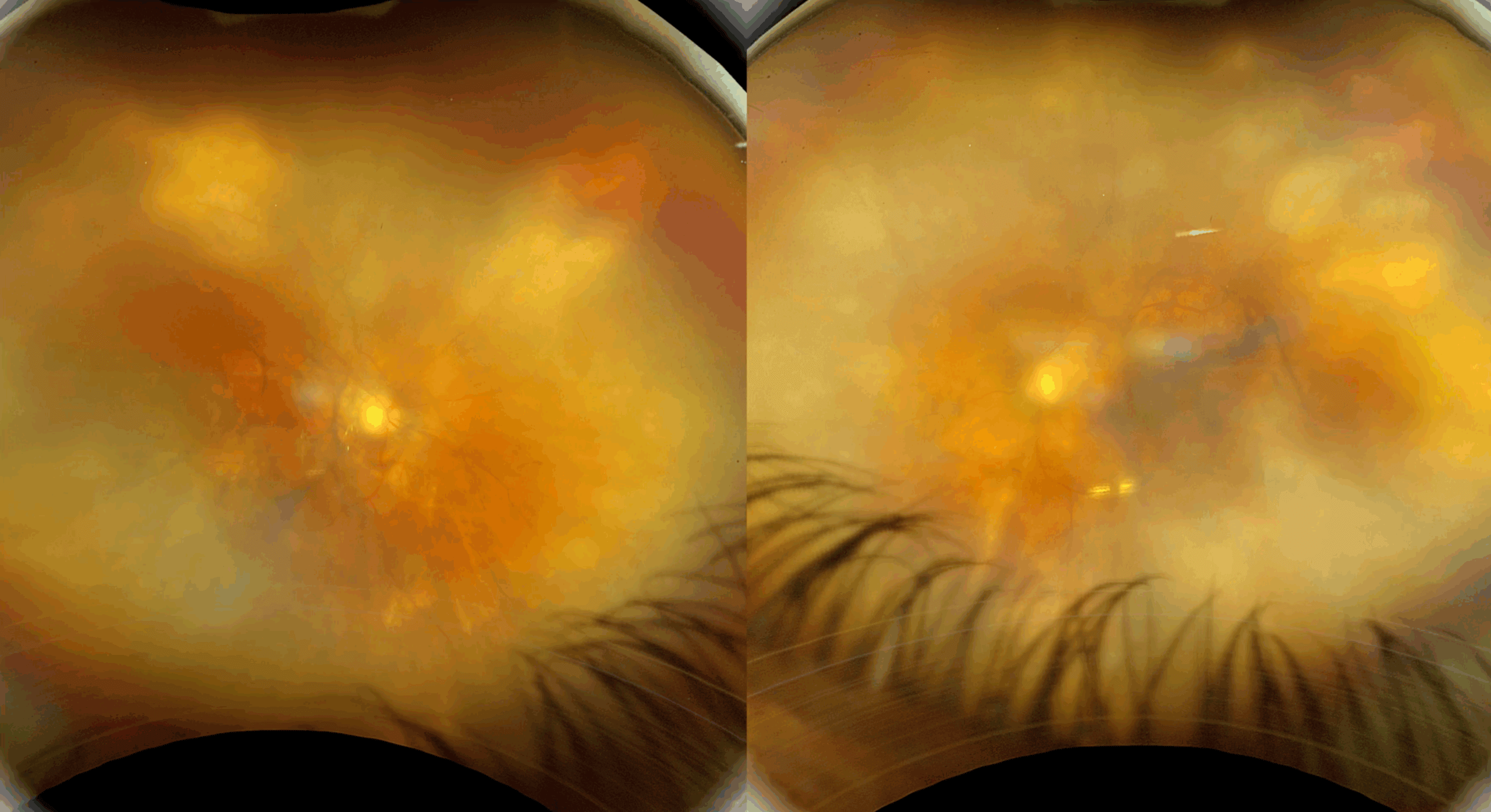 Eye Pathology Tips From Eyes to Slides | Wills Eye Hospital